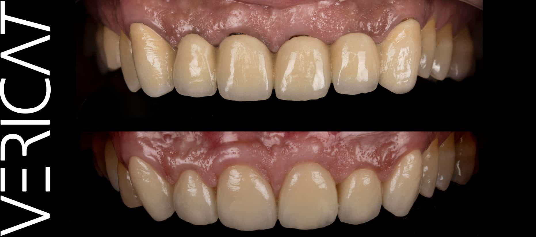 Técnica BOPT. Caso clínico - Clínica Dental VIF